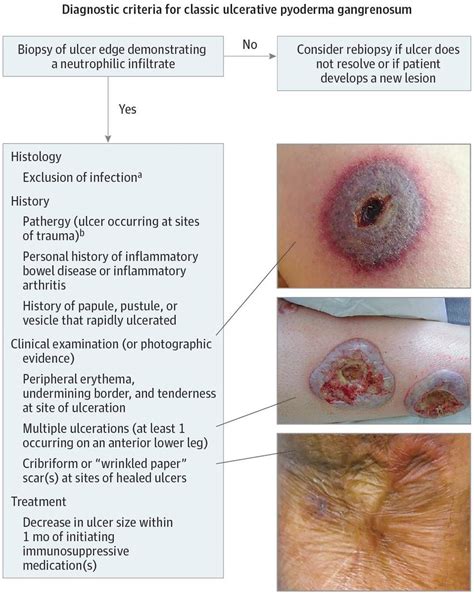 Jama Diagnostic Criteria Of Ulcerative Pyoderma Gangrenosum A Delphi
