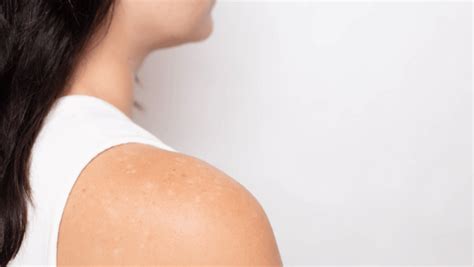 Cafe Au Lait Spots Appearance Causes And Considerations Clinikally