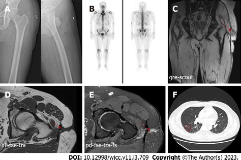 Figure 1 From Soft Tissue Tuberculosis Detected By Next Generation