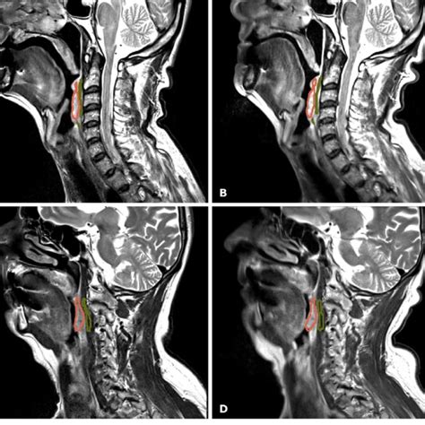 T2w Mri Using Turbo Spin Echo Tse Technique Of Two Patients A B