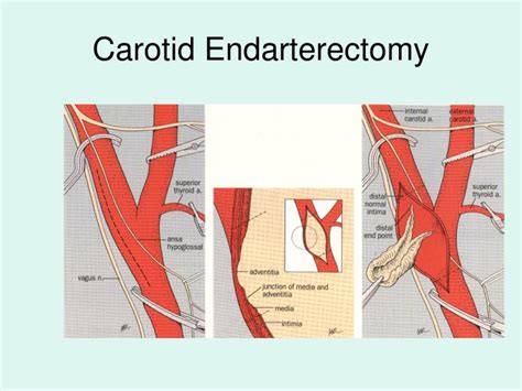 Ppt Surgical Intervention For Carotid Artery Disease Powerpoint Presentation Id 416629