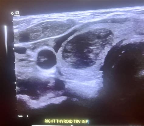 Thyroid Fna Rradiology