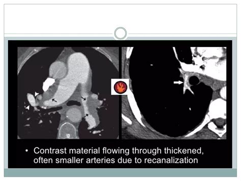 Pulmonary Embolism Radiology Pptx
