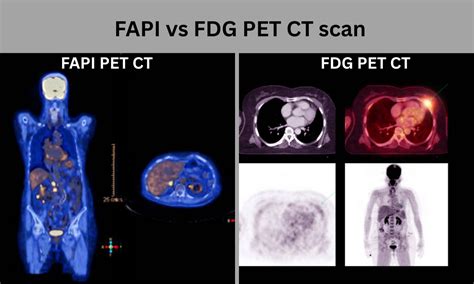 What Is A Pet Scan For Lung Cancer