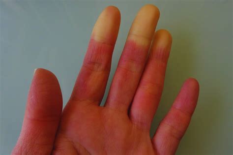 Scleroderma Signs Recognizing The Symptoms And Early Warning Signs Rheumatology Wellness