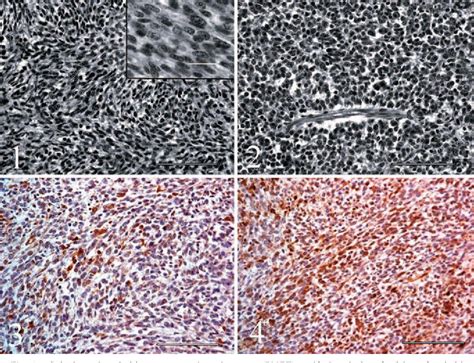 [pdf] Primitive Neuroectodermal Tumor In The Spinal Cord Of A Brahman Crossbred Calf Semantic