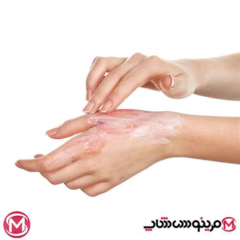 کرم سوختگی سودا کرم ۱۲۵گرم مرینوس شاپ