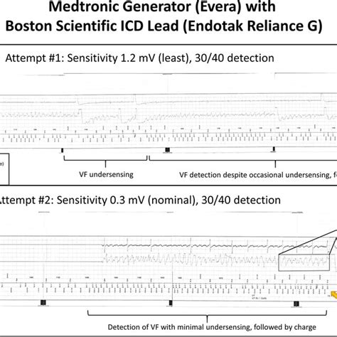Intracardiac Electrograms During Defibrillation Threshold Testing