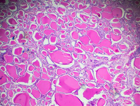 Difference Between Hypo Goiter And Hyper Goiter Difference Between Hypo Goiter Vs Hyper Goiter