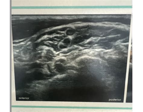 Interscalene Block Quiz