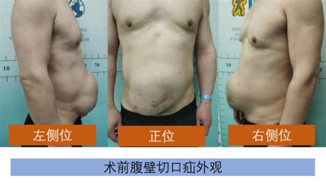 胃肠外科II科在MDT多学科诊疗下完成机器人辅助下腹壁巨大复发复杂切口疝修补术 中南大学湘雅三医院