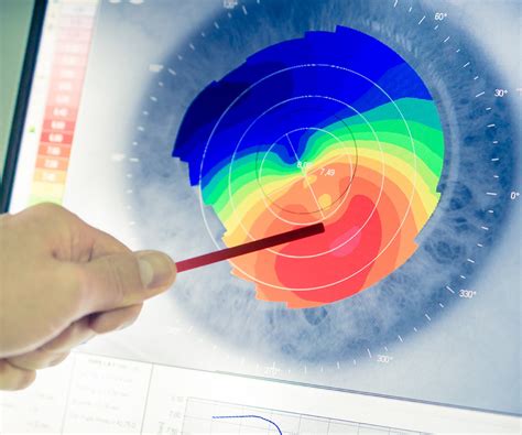 Contact Lenses For Treating Keratoconus دكتور محمد حنتيره