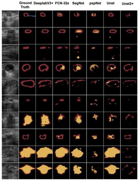 Biomedicines Free Full Text Improving Breast Cancer Detection And Diagnosis Through Semantic