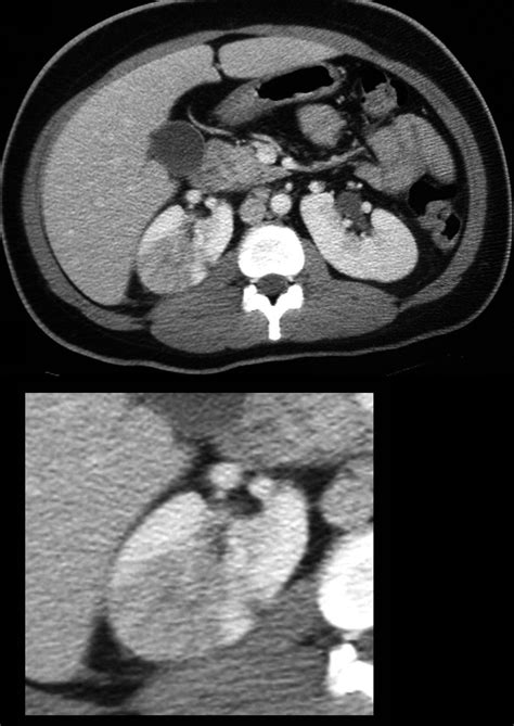Focal Finding The Common Vein