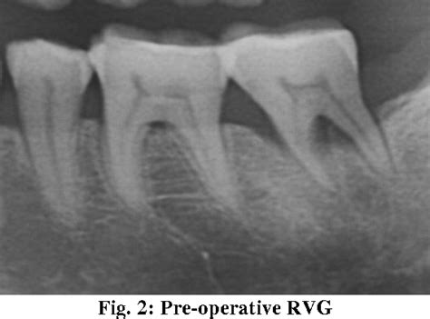 Figure 1 From Management Of Grade Ii Furcation Defect In Mandibular Molar With Alloplastic Bone