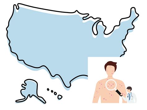 Monkeypox Cases Have Now Been Found In These 23 States Newsweek