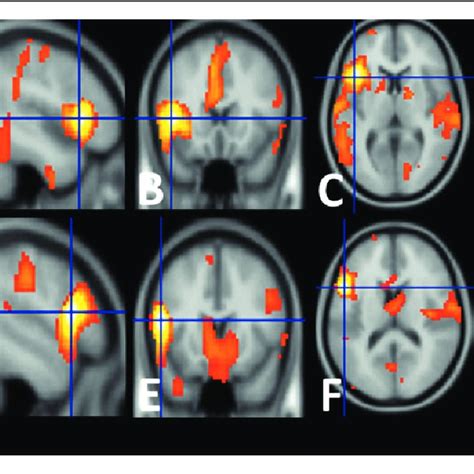 PDF Resting State FMRI A Review On Methods In Resting State Connectivity Analysis And Resting