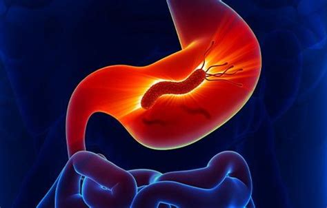 헬리코박터 파일로리균의 원인 감염증상 치료방법 헬리코박터균에 좋은 음식까지 완벽 정리