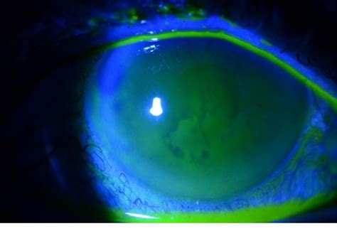 Pseudodendritic Epithelial Ulcer Stained With Fluorescein Using A Download Scientific Diagram