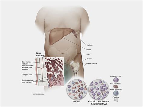 Chronic Lymphocytic Leukemia Diagram