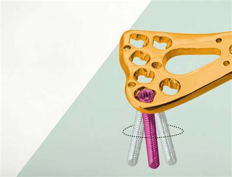 Variable Angle Locking Plates Types And Benefits Hemc Ortho