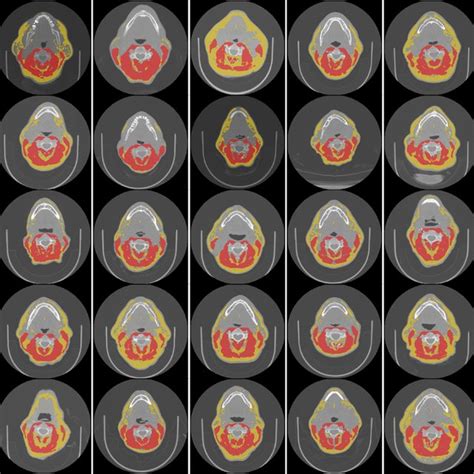 Segmentation Examples For A Subset Of 25 Cases Each Image Corresponds Download Scientific