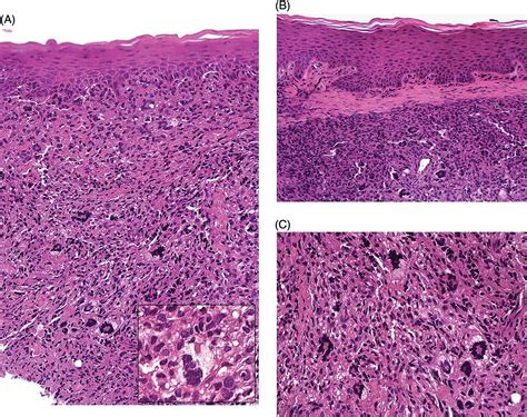 Juvenile Xanthogranuloma Histology Juvenile Xanthogranuloma Histology