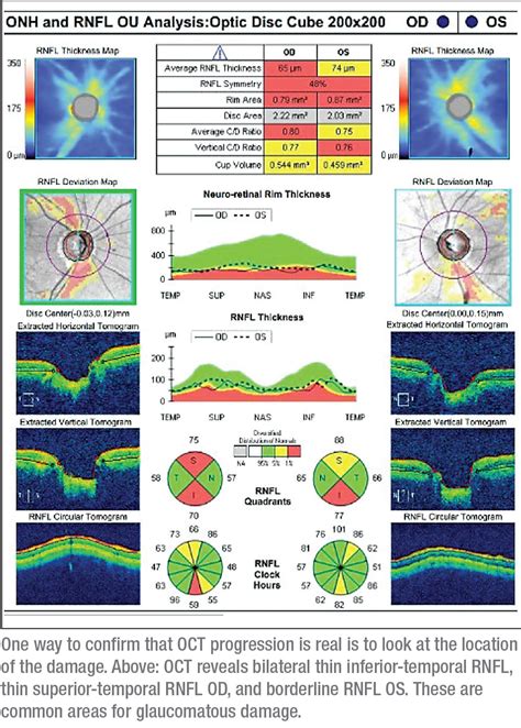 Glaucoma Visual Field Defects