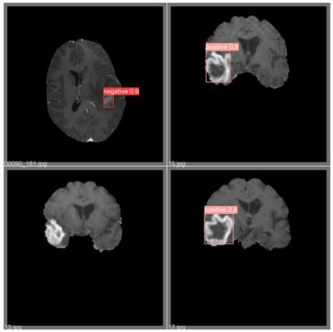 enhancing automated brain tumor detection accuracy using artificial