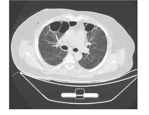On Thorax Ct Bullae Are Observed In The Middle Lobe Of The Right Lung