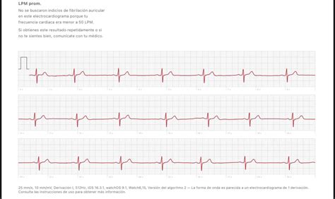 Sinus Bradycardia