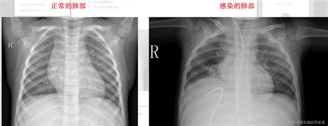 Pytorch Resnet网络结构 疾病感染图片诊断 有代码数据 可直接运行 Csdn博客