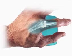 MCP Joint Replacement Treatments Services In New Delhi Nova Orthopaedic Spine Hospital ID