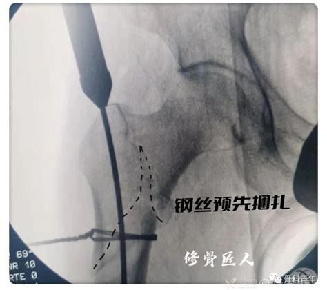 实战经验：髓内钉固定治疗股骨转子间骨折10条推荐（上篇 1 3） 好医术文章 好医术 赋能医生守护生命