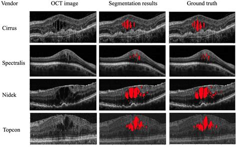A Review Of Machine Learning Algorithms For Retinal Cyst Segmentation
