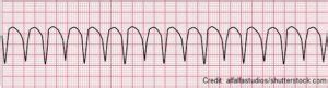 Ventricular Tachycardia V Tach ECG EKG Review Nursing