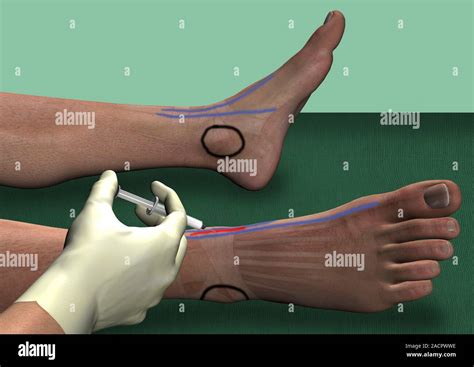 Deep Fibular Nerve Block Artwork Of A Syringe Being Used To Inject A Local Anaesthetic To Numb
