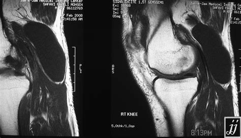 Large Popliteal Cyst Radiopaedia