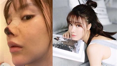 Chinese Actress Gao Lius Nose Job Went So Horribly Wrong The Tip Of