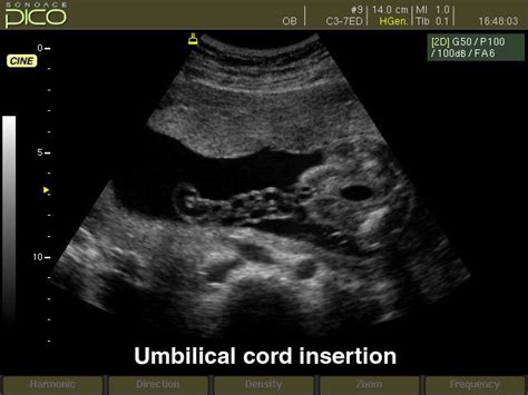 Ultrasound Images Umbilical Cord Insertion B Mode Echogramm №256