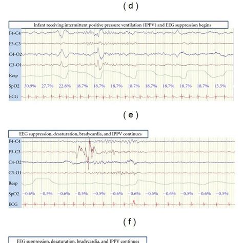 Pdf Eeg Suppression Associated With Apneic Episodes In A Neonate