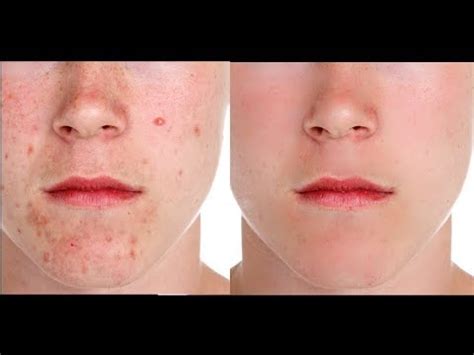 High End Skin Softening In Gimp Remove Blemishes Wrinkles Acne