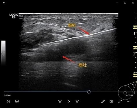 超声引导下穿刺活检图第5页大山谷图库
