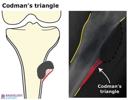 Osteosarcoma X Ray Codmans Triangle Jmsr