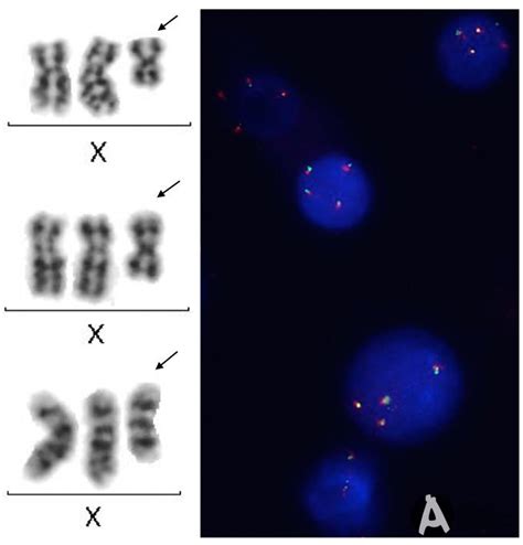 I X P10 In Female Patients