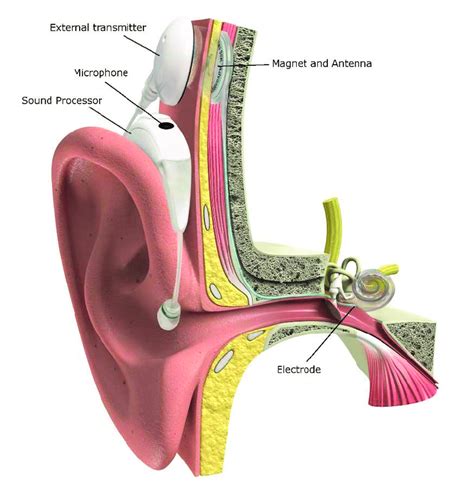 Cochlear Implant System With Courtesy Of Advanced Bionics Download Scientific Diagram