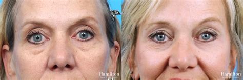 Blepharoplasty Before And After Gallery