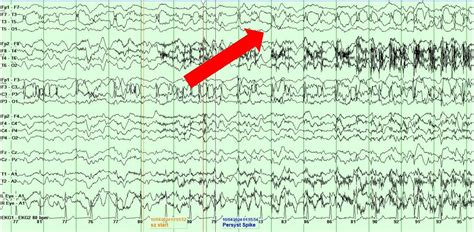 A Rare Case Of Contralateral Onset Of Seizures And Sirpids Stimulus