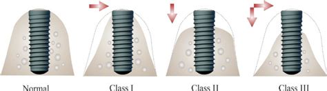 Bone Volume Insufficiency For Implant Placement In Siebert Class I