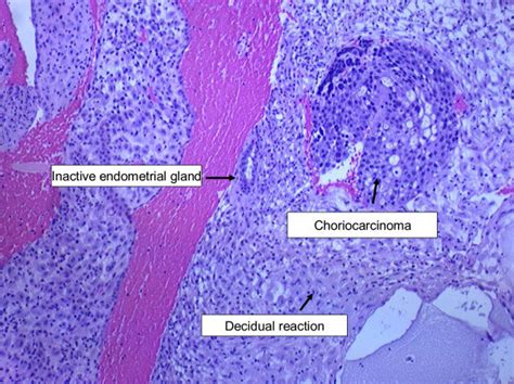 Endometrial Biopsy Showing Choriocarcinoma With Decidual Reaction